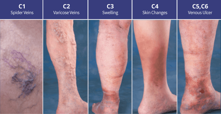 Varicose Veins In Legs Feet Melbourne Heidelberg Richmond Epping Varicose Veins In Legs Feet Melbourne Heidelberg Richmond Epping